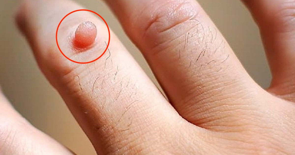 Verruche, come eliminarle in 48 ore con un rimedio naturale fatto in casa